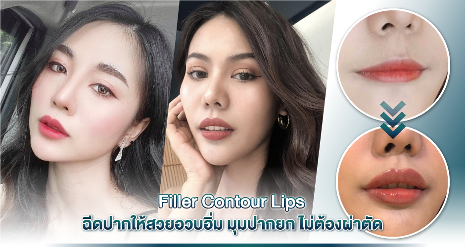 Filler Contour Lips ฉีดฟิลเลอร์ยกมุมปากให้สวยอวบอิ่ม โดยไม่ต้องผ่าตัด