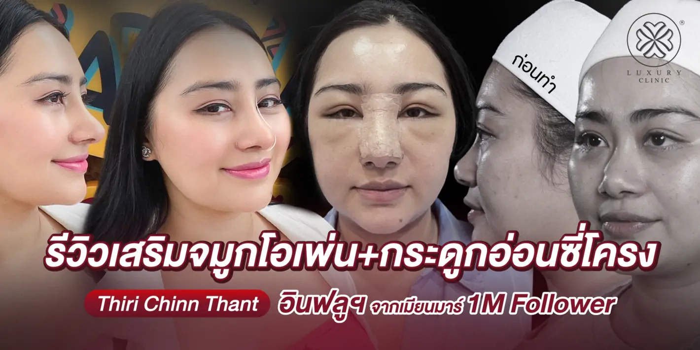 รีวิวเสริมจมูกโอเพ่นกระดูกอ่อนซี่โครง Thiri Chinn Thant อินฟลูเอนเซอร์ ...